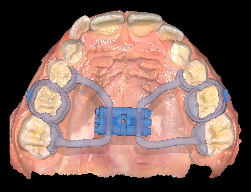 Rapid palatal expansion appliance (RPE) | Ortho-Guru