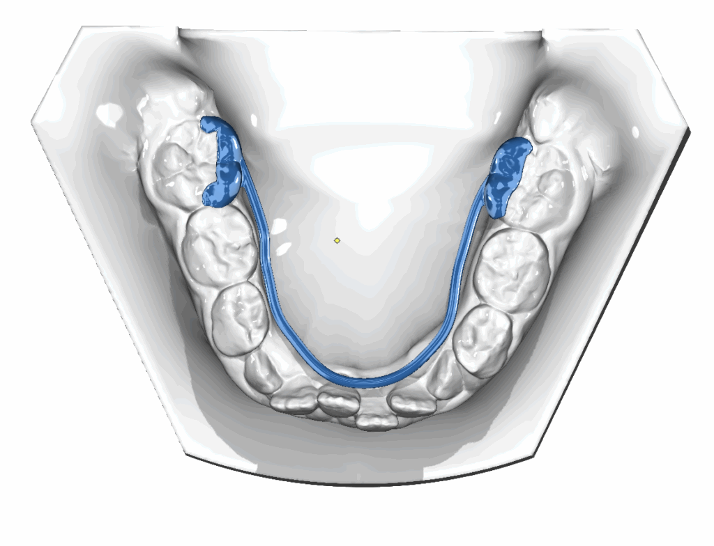 Trans-palatal-/Lingual Arch – Ortho-Guru.com